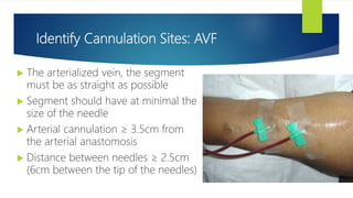 AV Vascular Access - Hemodialysis | PPTX