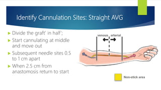 AV Vascular Access - Hemodialysis | PPTX