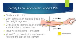 AV Vascular Access - Hemodialysis | PPTX