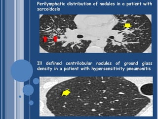 The basic interpretation of hrct | PPT