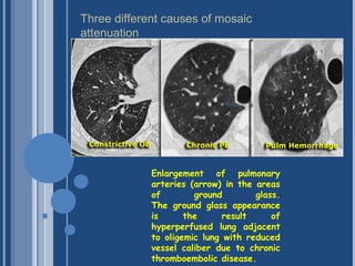 The basic interpretation of hrct | PPT