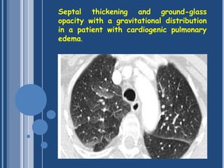 The basic interpretation of hrct | PPT
