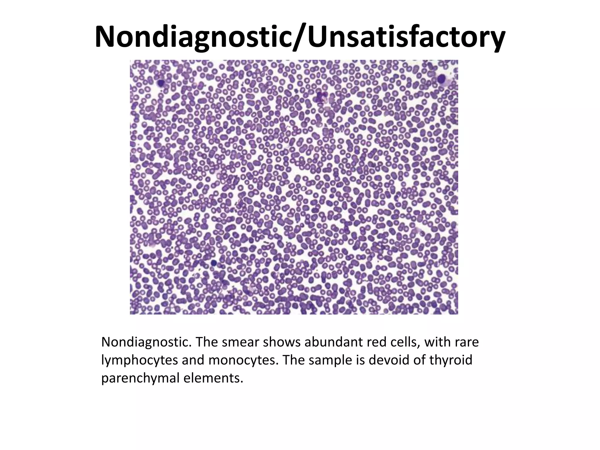 The bethesda system for reporting thyroid cytopathology | PPTX