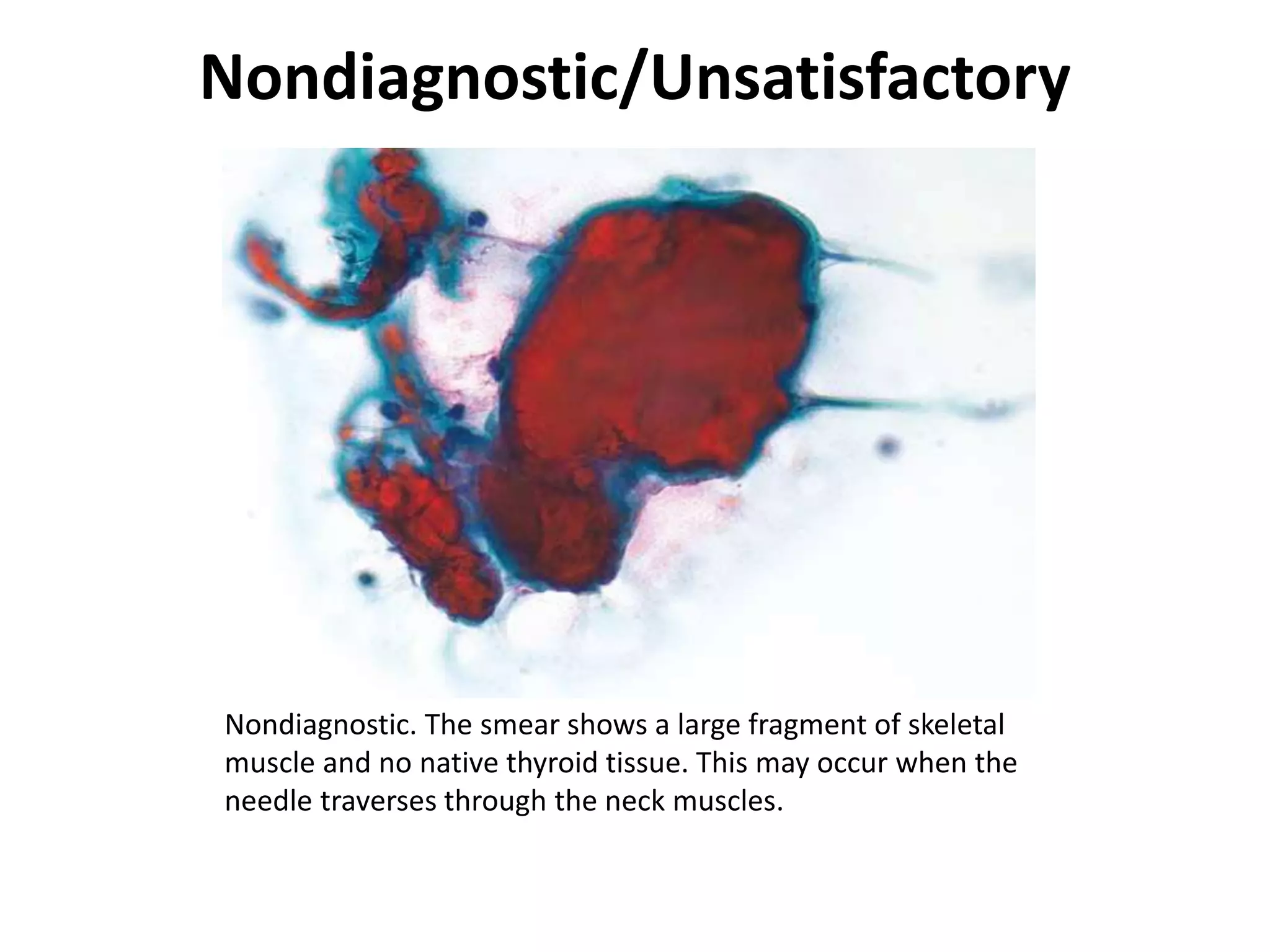 The bethesda system for reporting thyroid cytopathology | PPTX