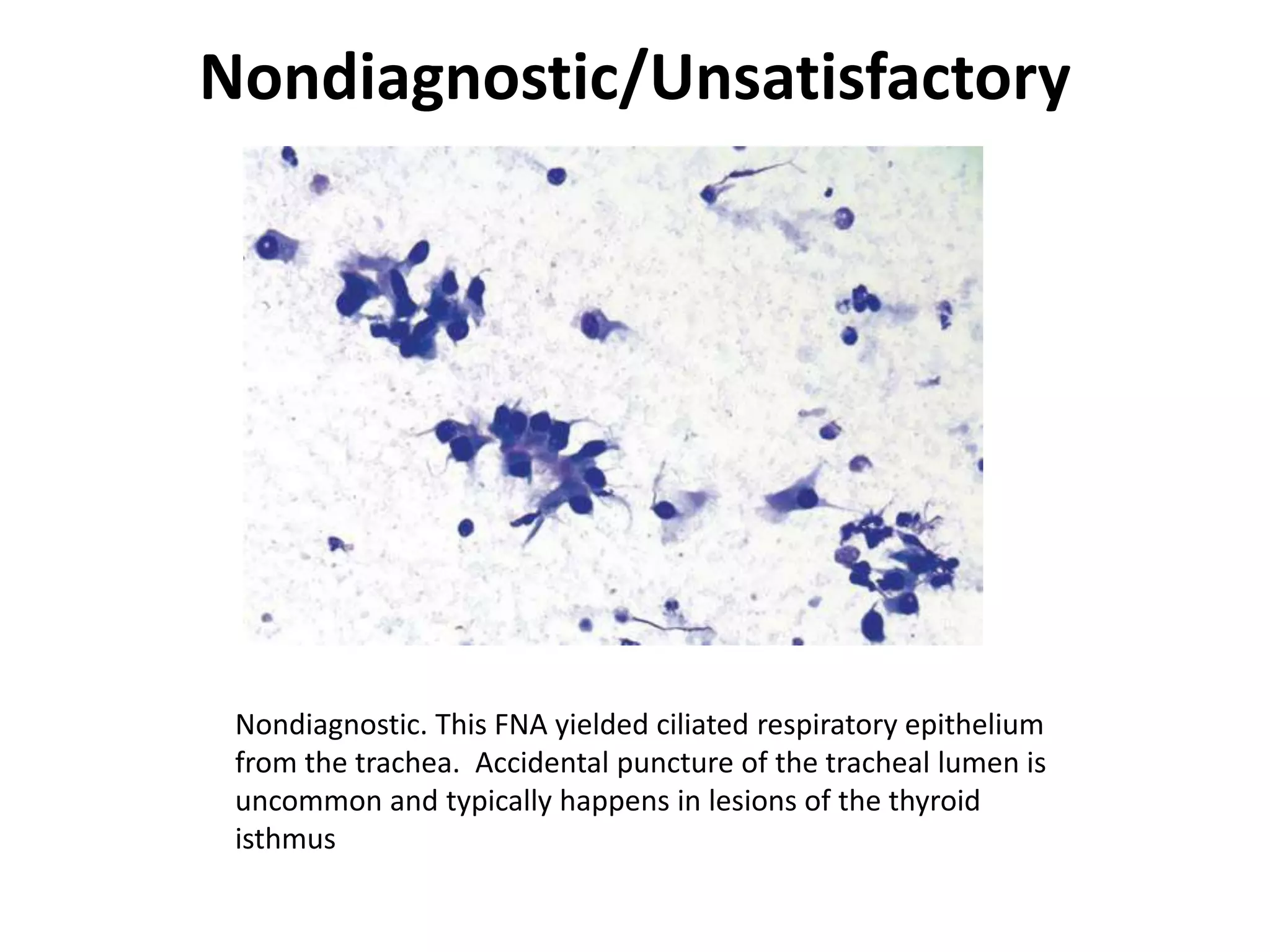 The bethesda system for reporting thyroid cytopathology | PPTX