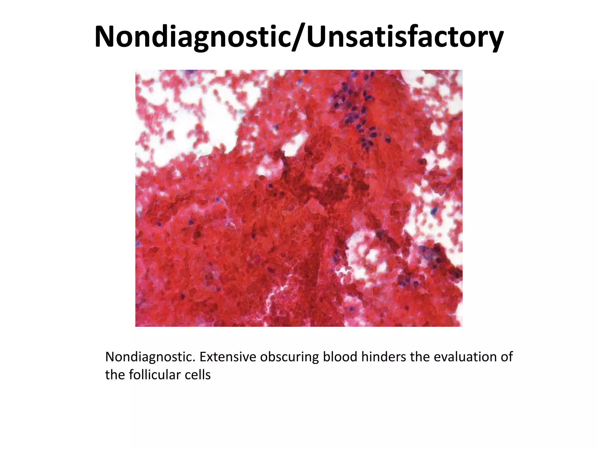 The bethesda system for reporting thyroid cytopathology | PPTX