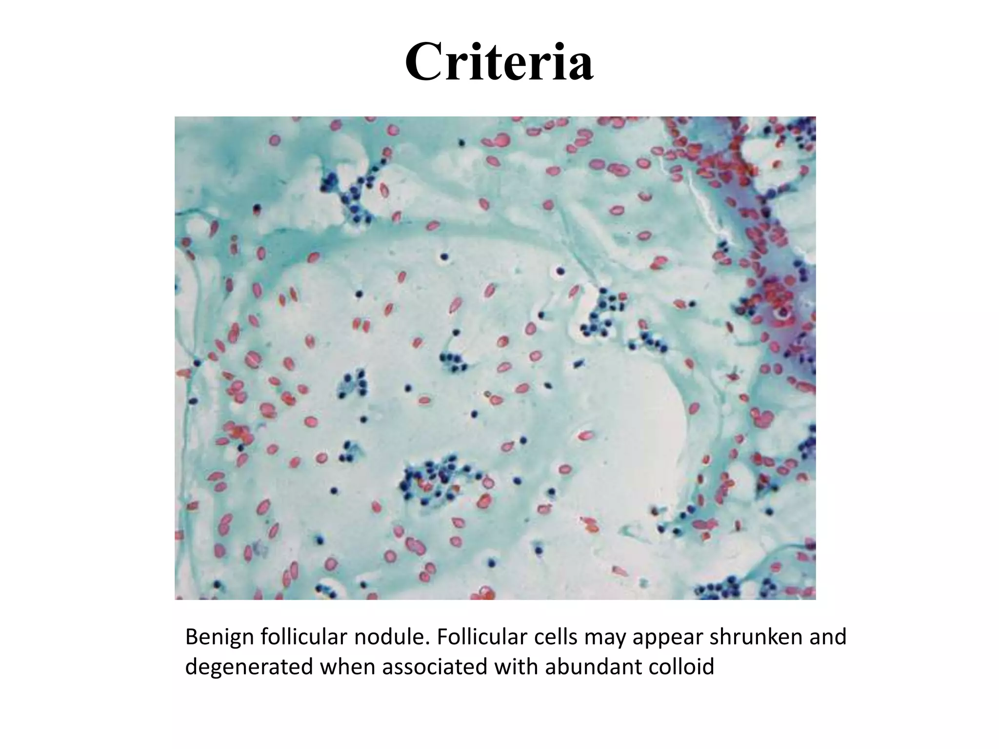 The bethesda system for reporting thyroid cytopathology | PPTX