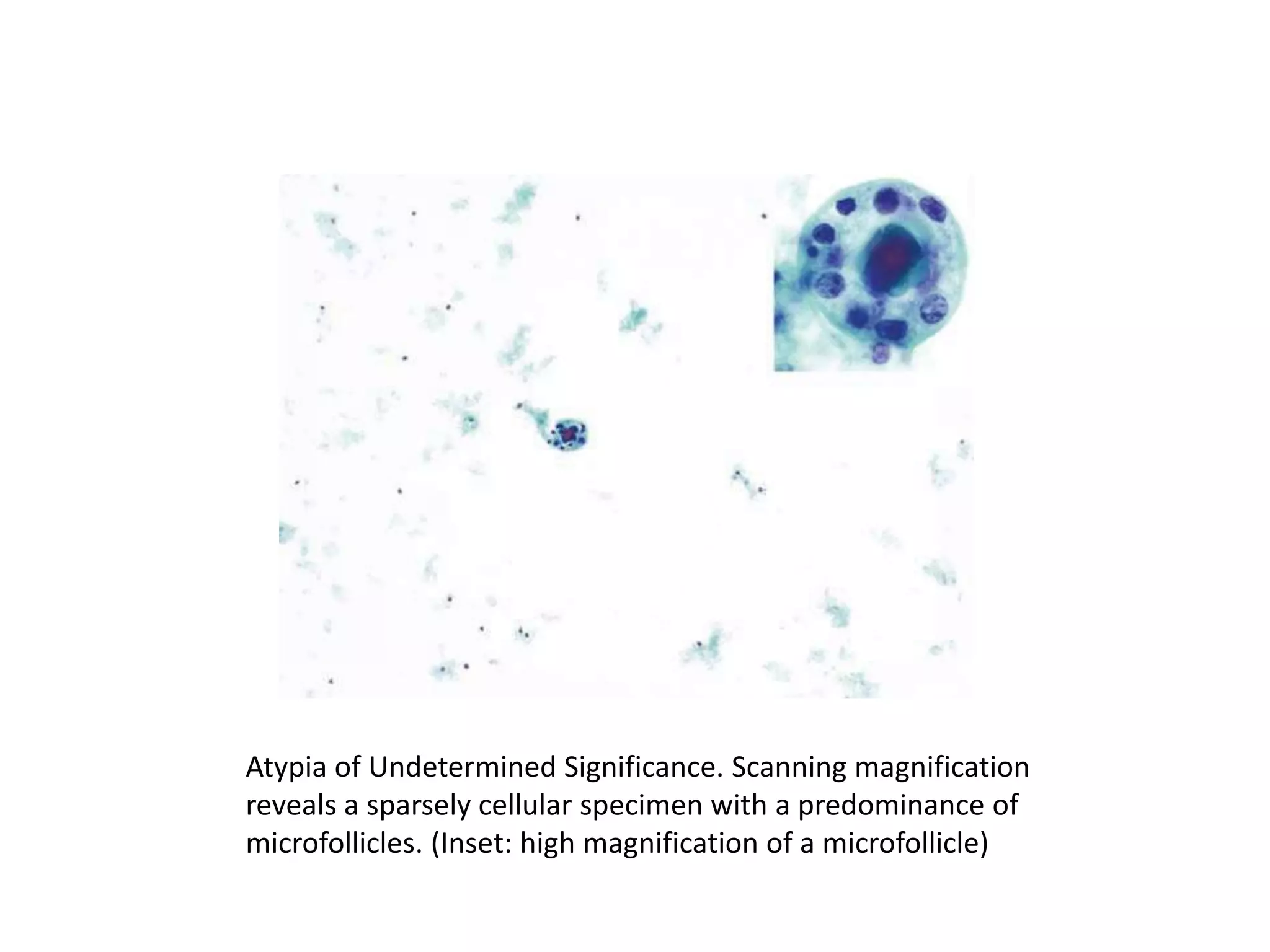 The bethesda system for reporting thyroid cytopathology | PPTX
