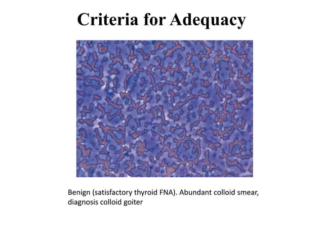 The bethesda system for reporting thyroid cytopathology | PPTX