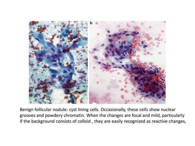 The bethesda system for reporting thyroid cytopathology | PPTX