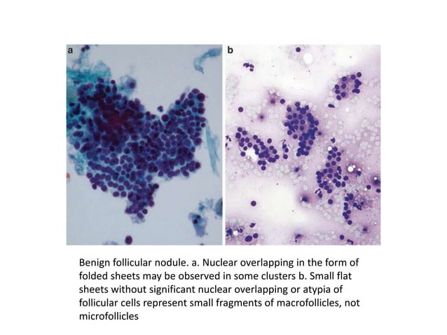 The bethesda system for reporting thyroid cytopathology | PPTX