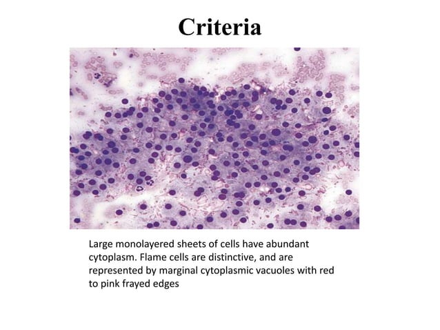 The bethesda system for reporting thyroid cytopathology | PPTX