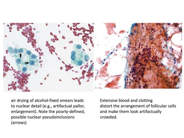 The bethesda system for reporting thyroid cytopathology | PPT
