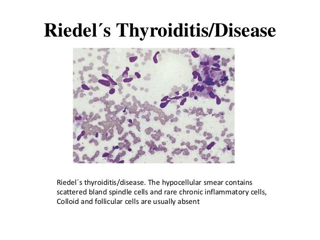 The bethesda system for reporting thyroid cytopathology