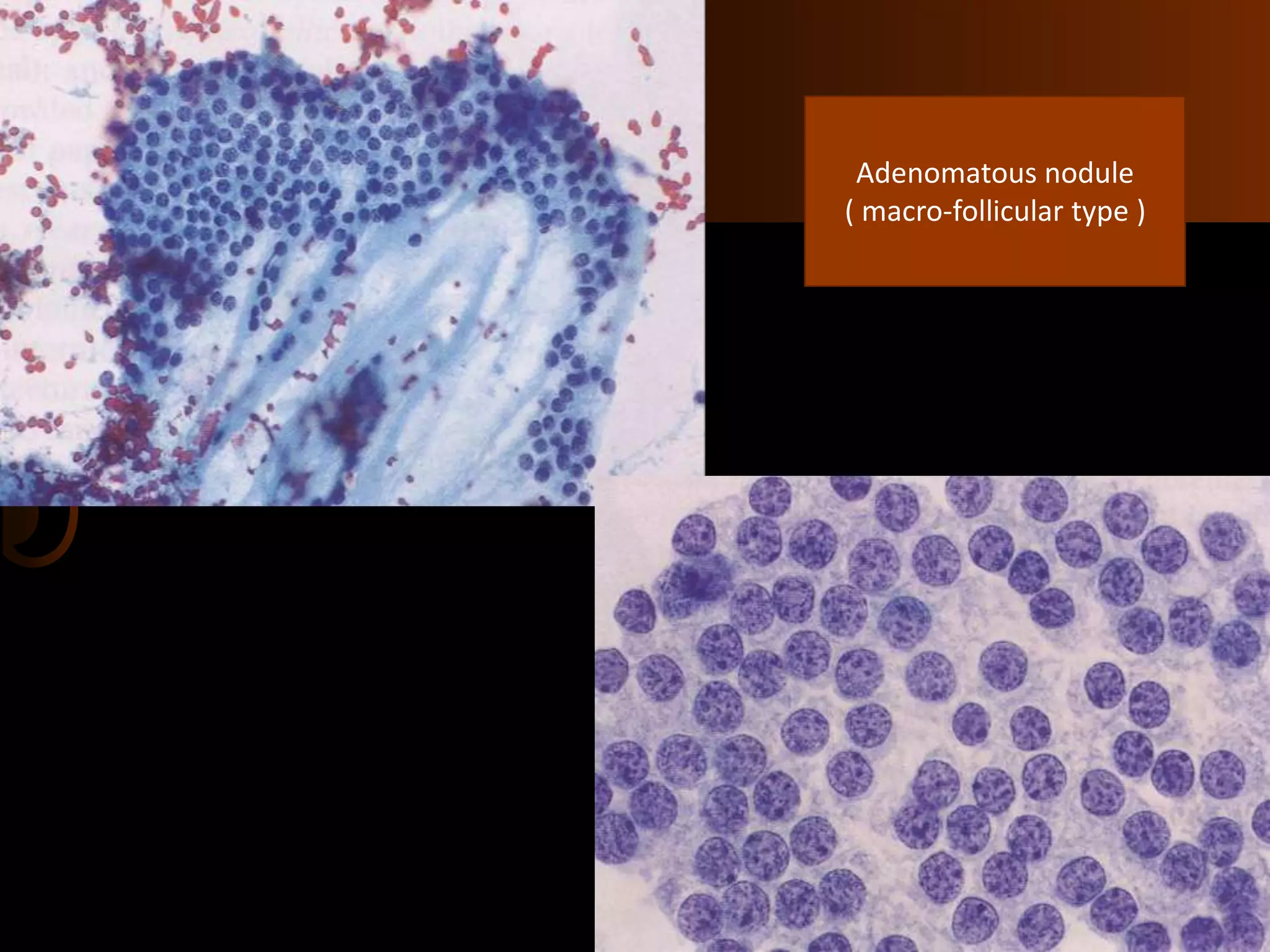 The bethesda system for reporting thyroid cytopathology | PPTX