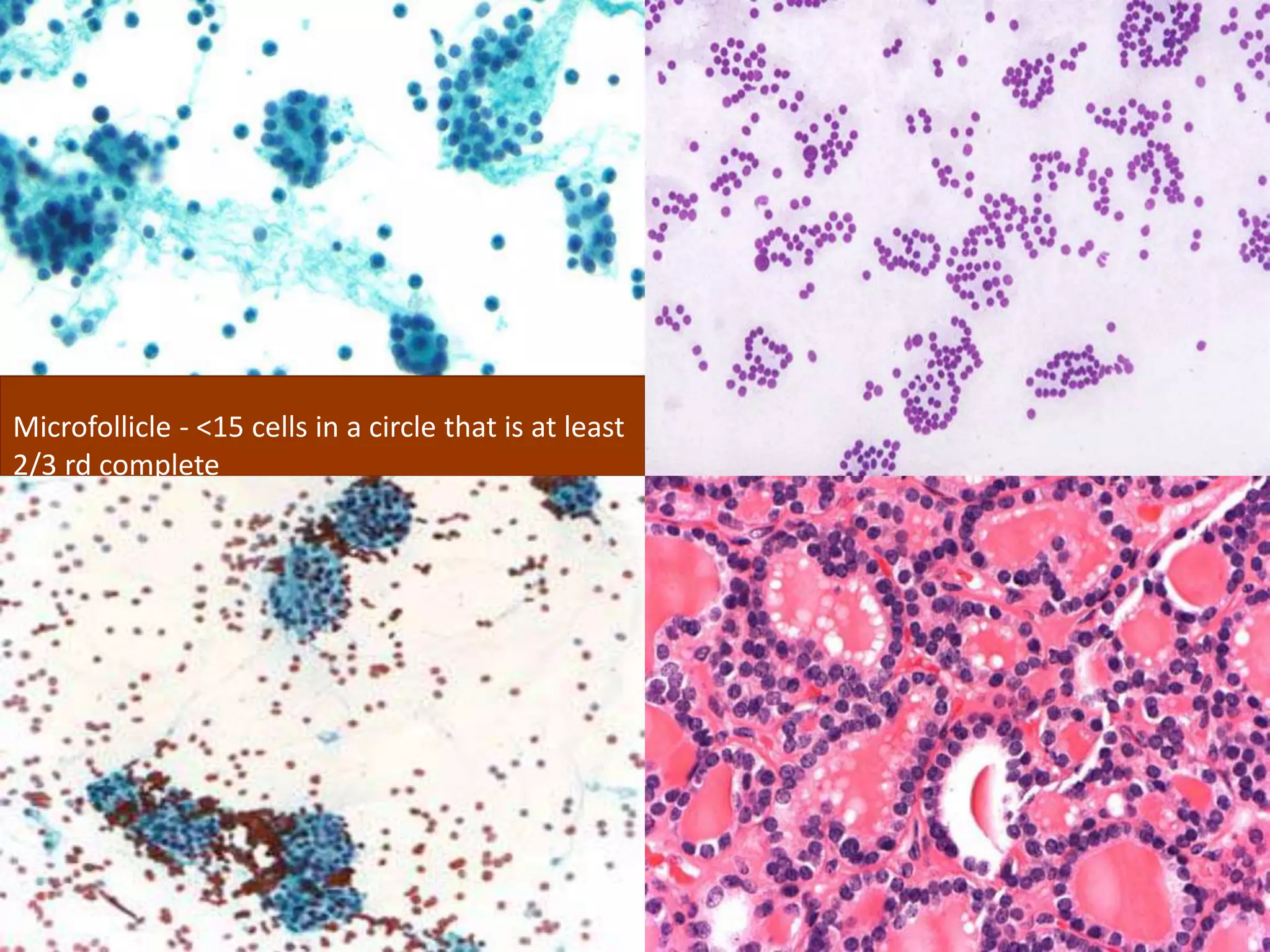 The bethesda system for reporting thyroid cytopathology | PPTX