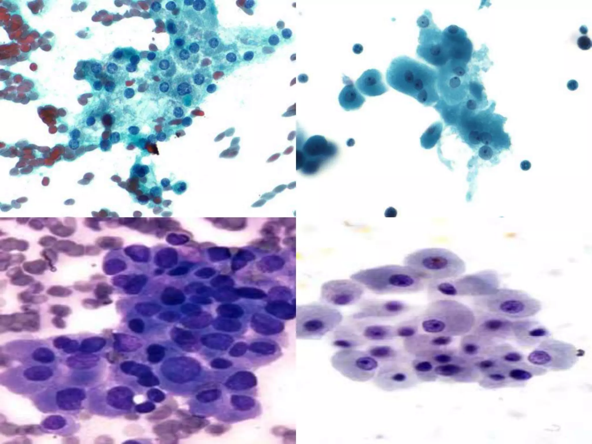The bethesda system for reporting thyroid cytopathology | PPTX