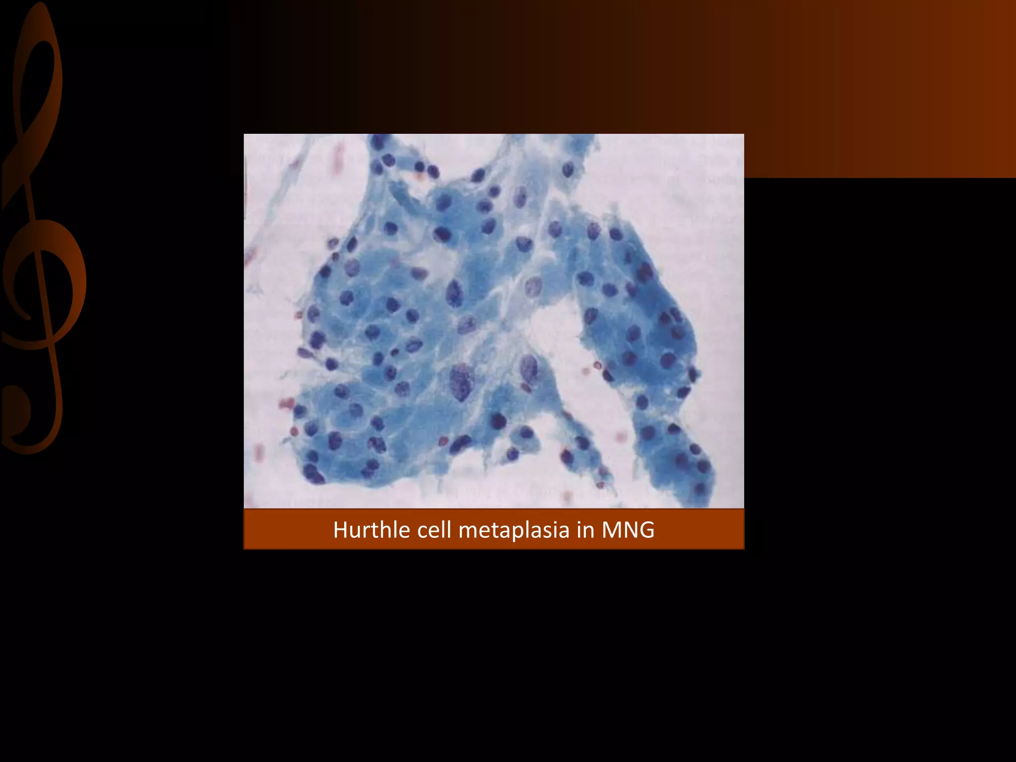 The bethesda system for reporting thyroid cytopathology | PPTX