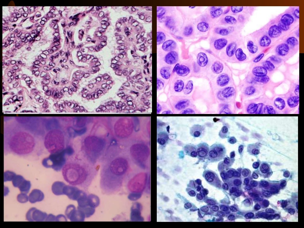 The bethesda system for reporting thyroid cytopathology