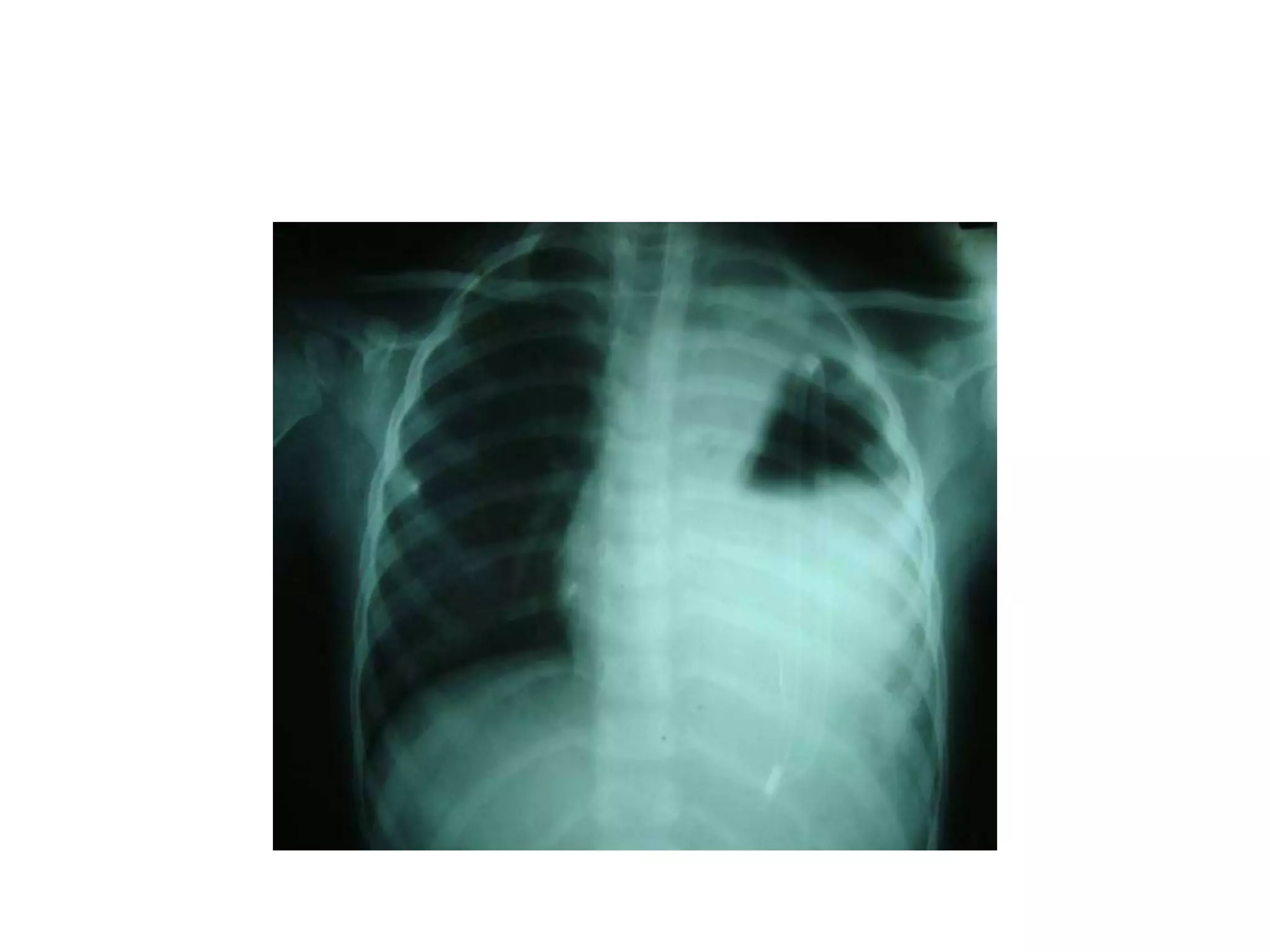 The blunt cp angle in trauma pts-diaphragmatic hernias | PPTX | Death ...