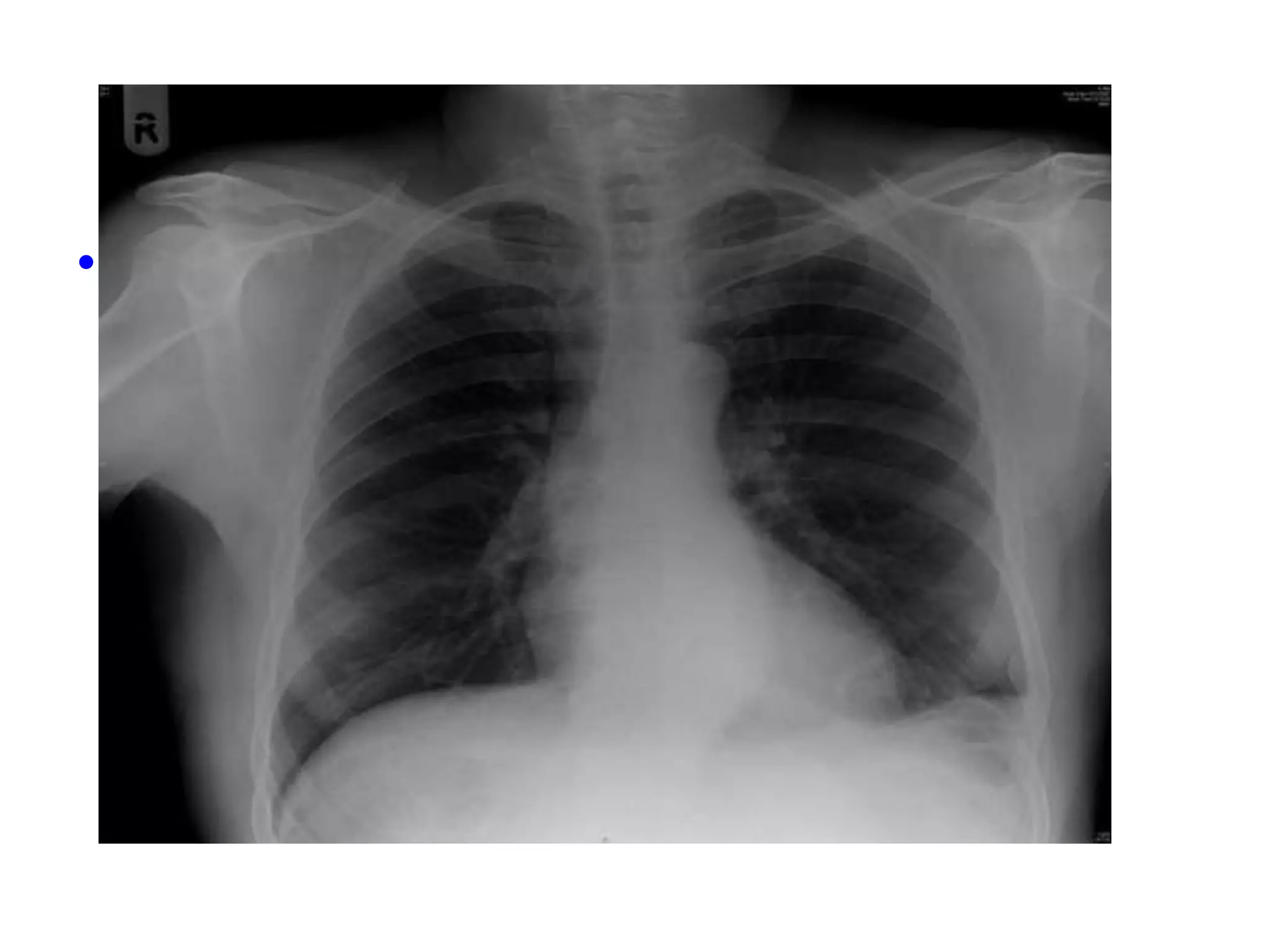 The blunt cp angle in trauma pts-diaphragmatic hernias | PPT