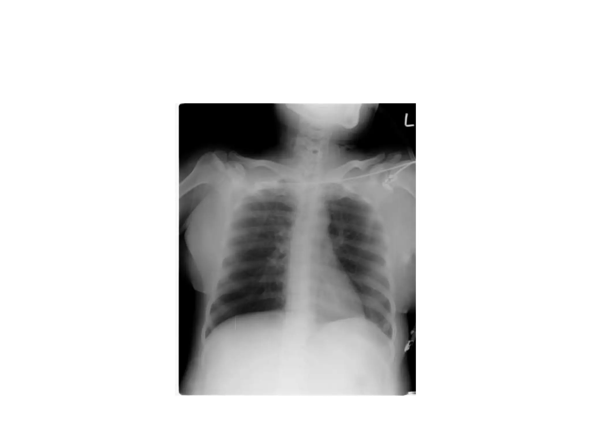 The blunt cp angle in trauma pts-diaphragmatic hernias | PPTX | Death ...