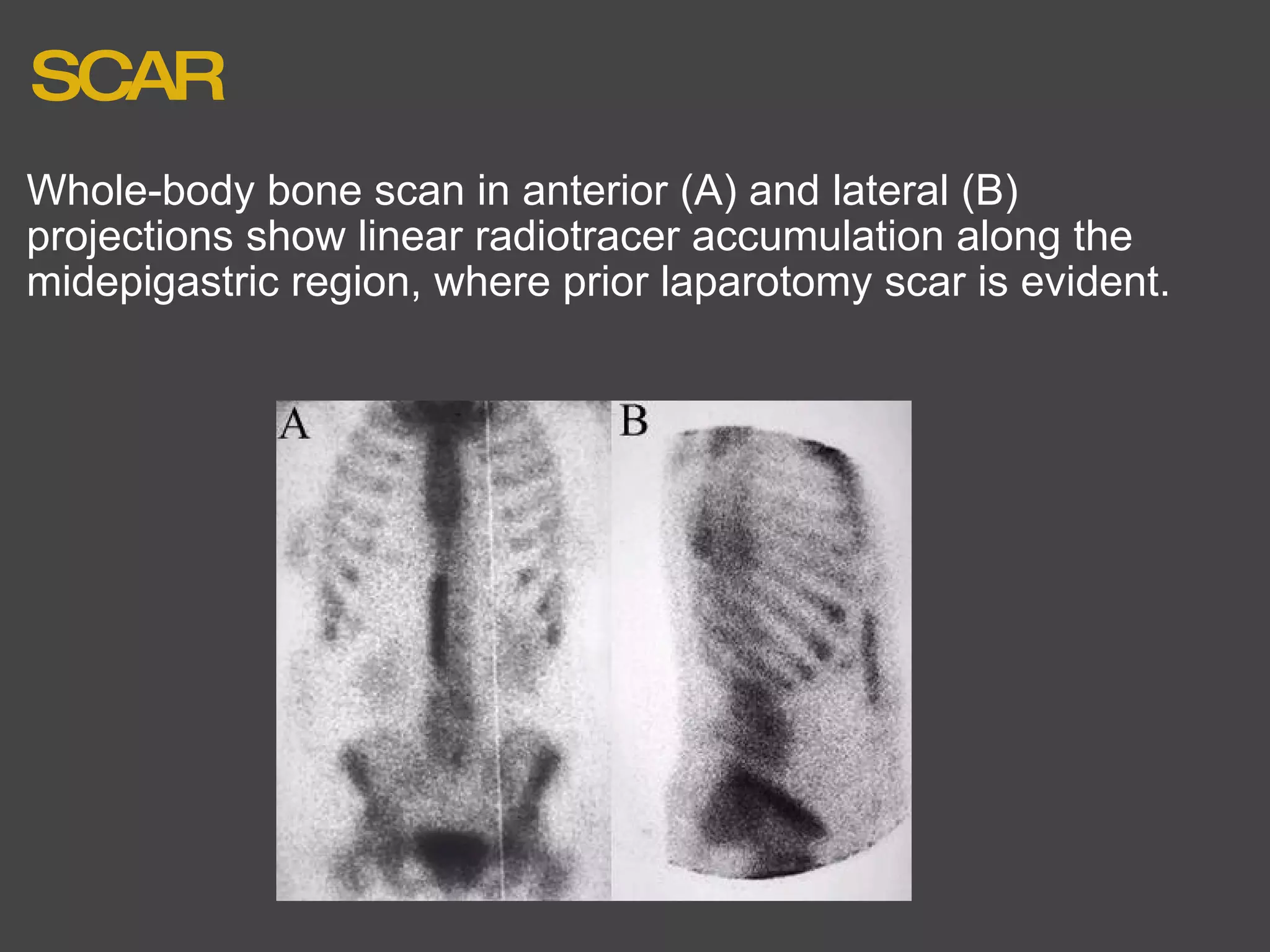 The Bone Scan | PPT