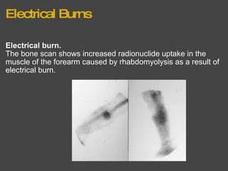 The Bone Scan | PPT