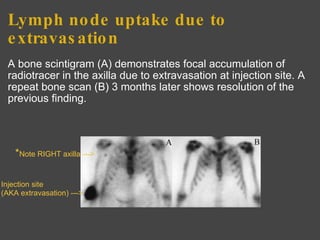 The Bone Scan | PPT