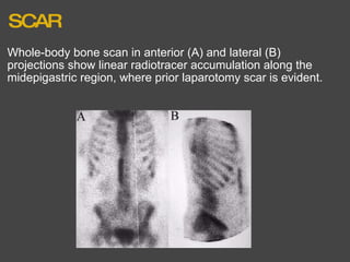 The Bone Scan | PPT