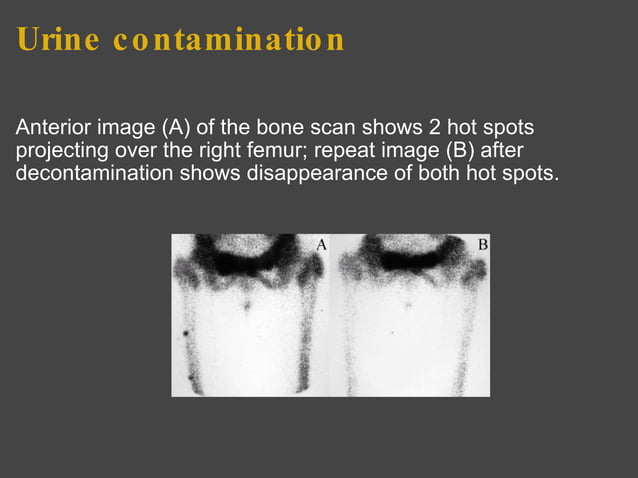 The Bone Scan | PPT