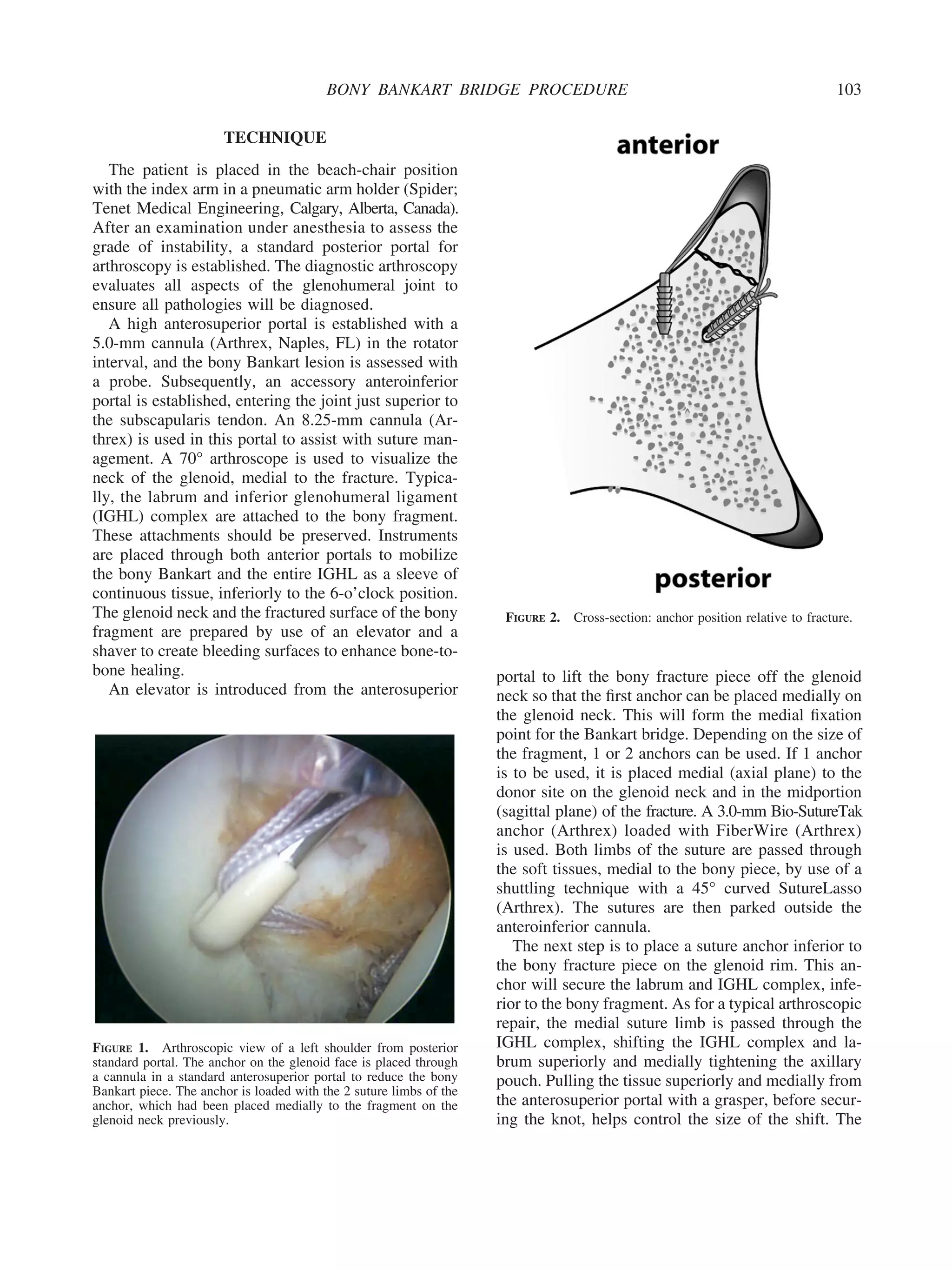 The “Bony Bankart Bridge” Procedure Shoulder Instability | Shoudler ...