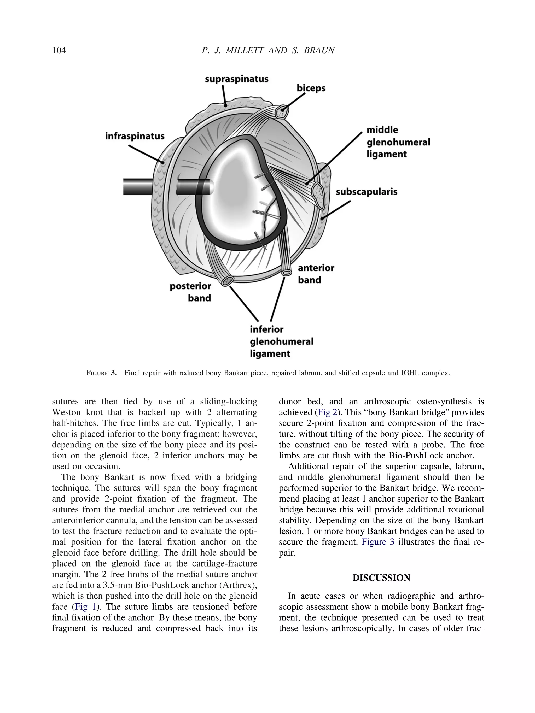 The “Bony Bankart Bridge” Procedure Shoulder Instability | Shoudler ...