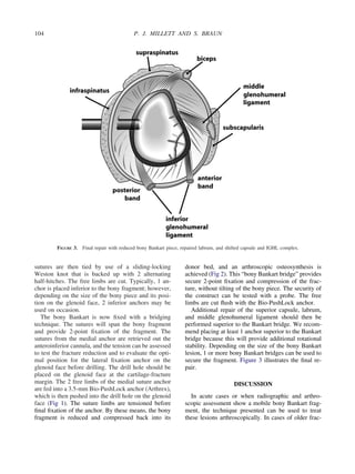 The “Bony Bankart Bridge” Procedure Shoulder Instability | Shoudler ...