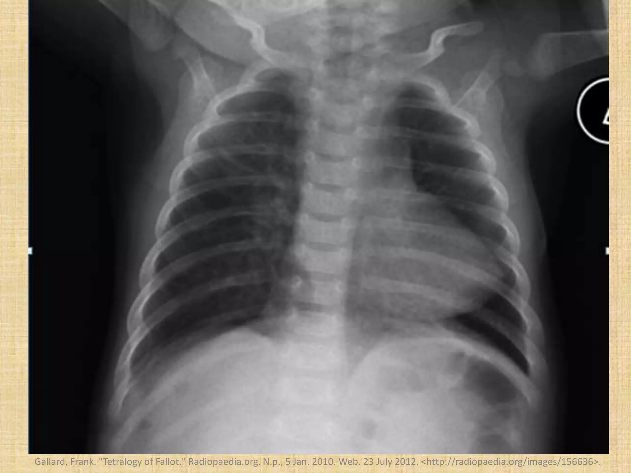 The boot shaped heart sign | PPTX