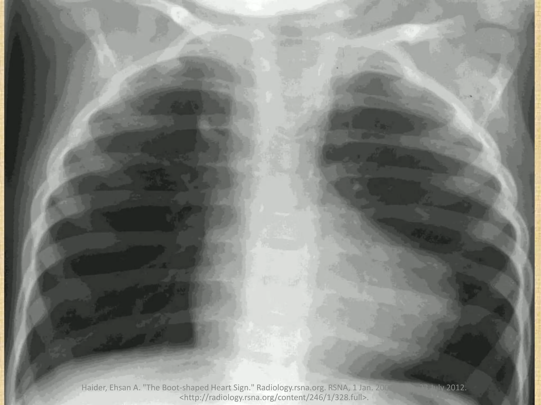 The boot shaped heart sign | PPTX