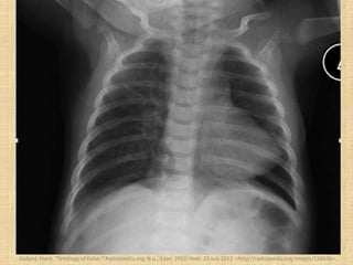 The boot shaped heart sign | PPTX