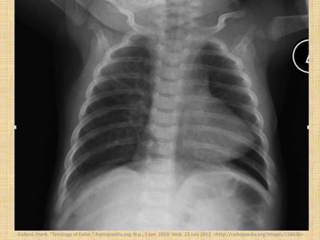 The boot shaped heart sign | PPTX