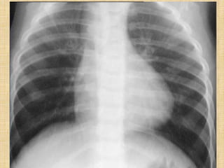 The boot shaped heart sign | PPTX