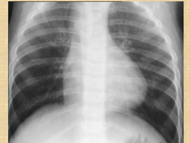 The boot shaped heart sign | PPTX