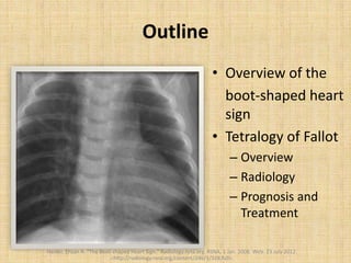 The boot shaped heart sign | PPTX