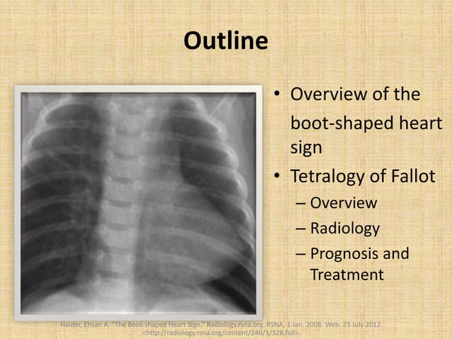 The boot shaped heart sign | PPTX