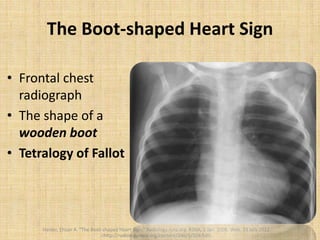 The boot shaped heart sign | PPT