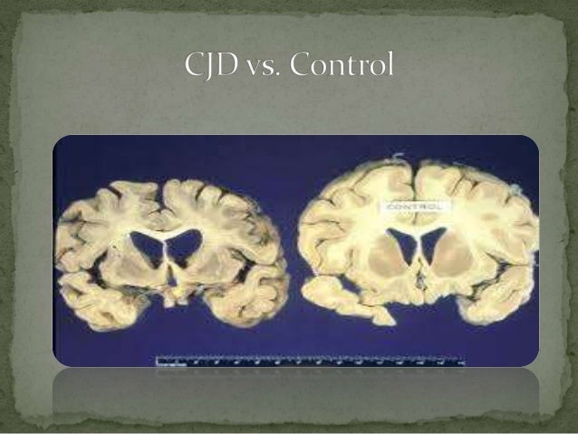 The brain eater (Creutzfeldt Jakob Disease)