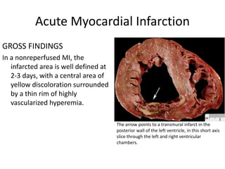 Myocardial Infarction Gross