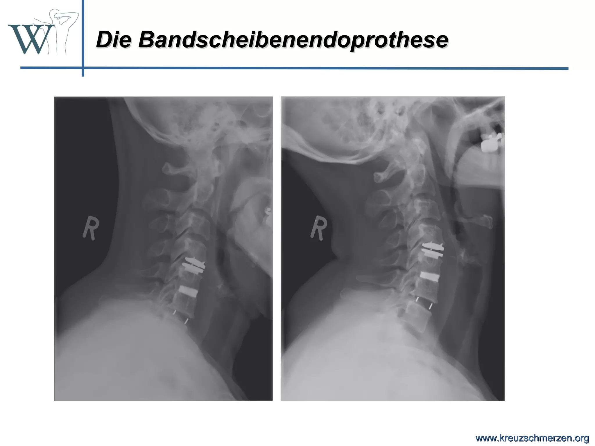 The cervical myelopathy. | PPT