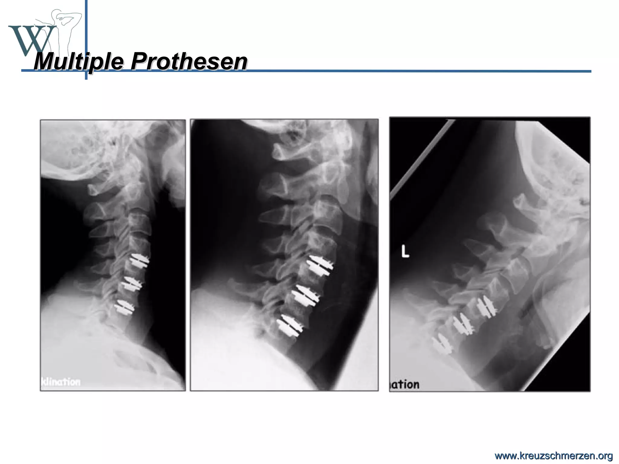 The cervical myelopathy. | PPT