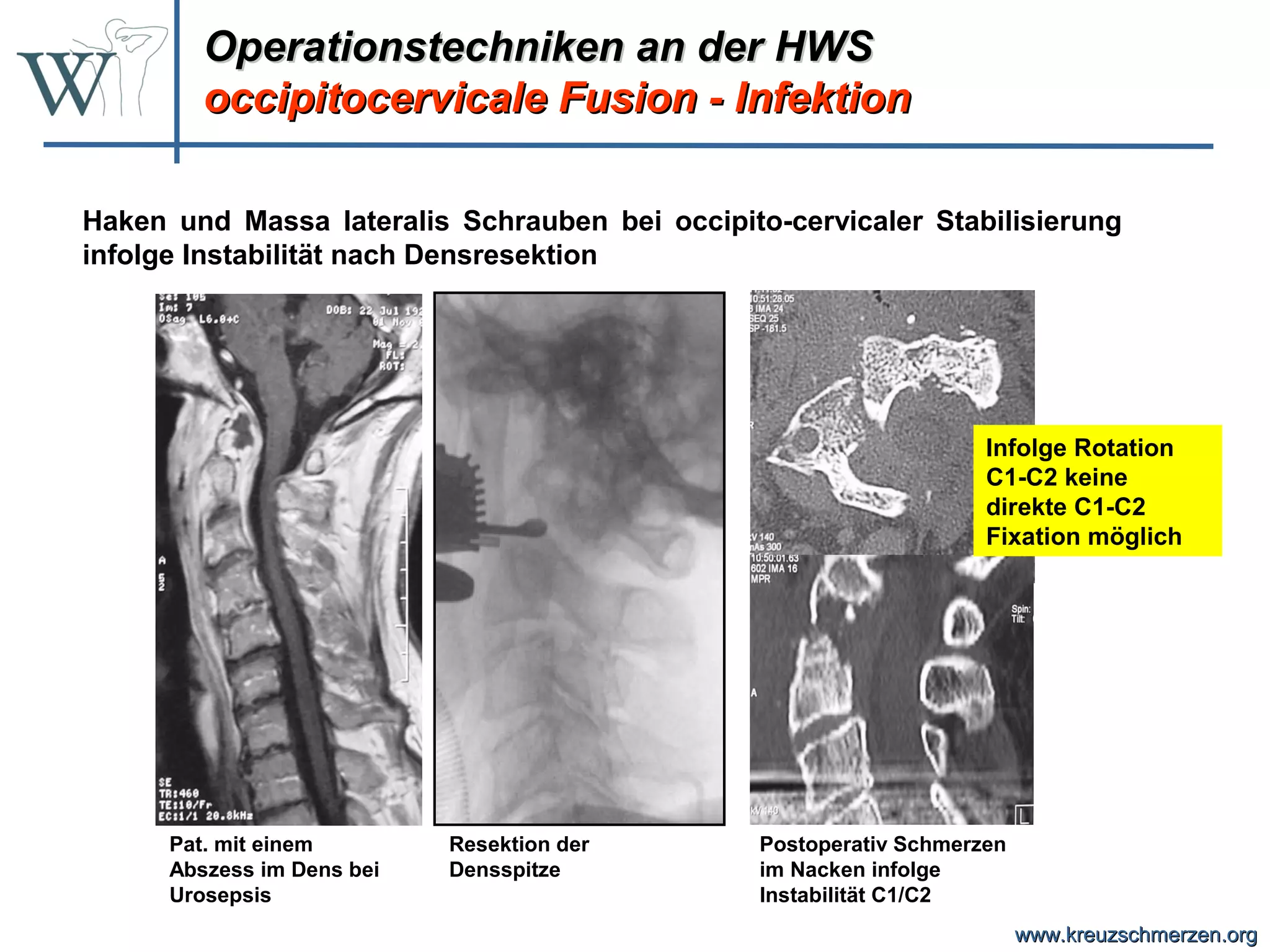 The cervical myelopathy. | PPT