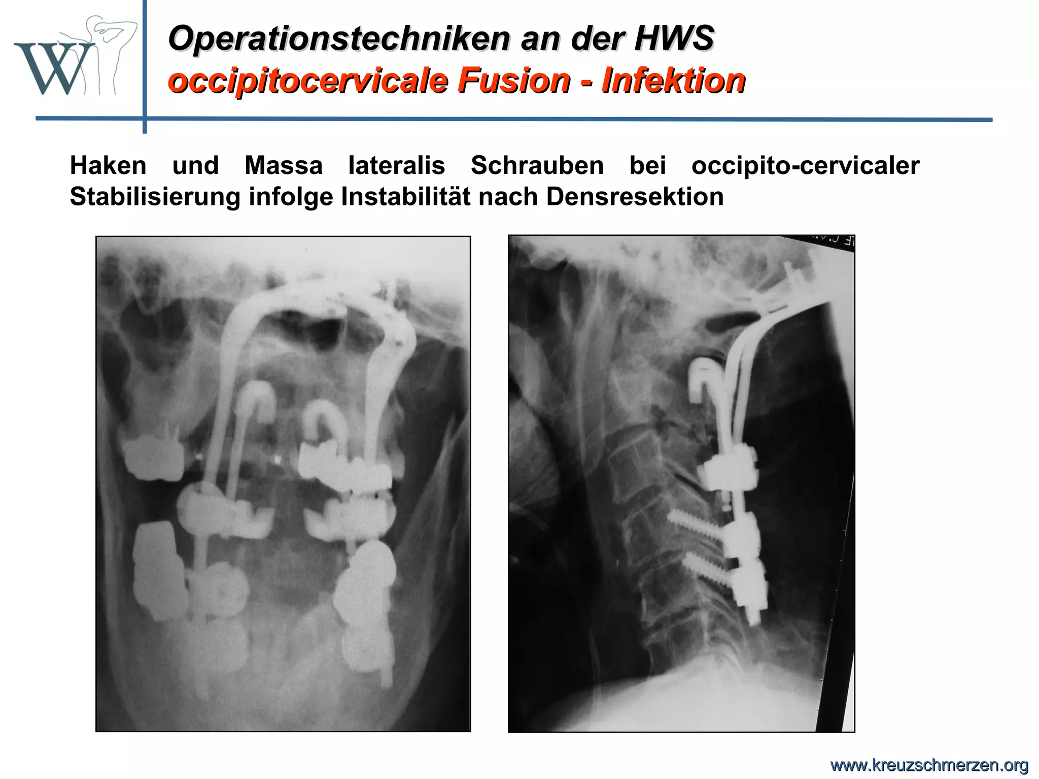 The cervical myelopathy. | PPT
