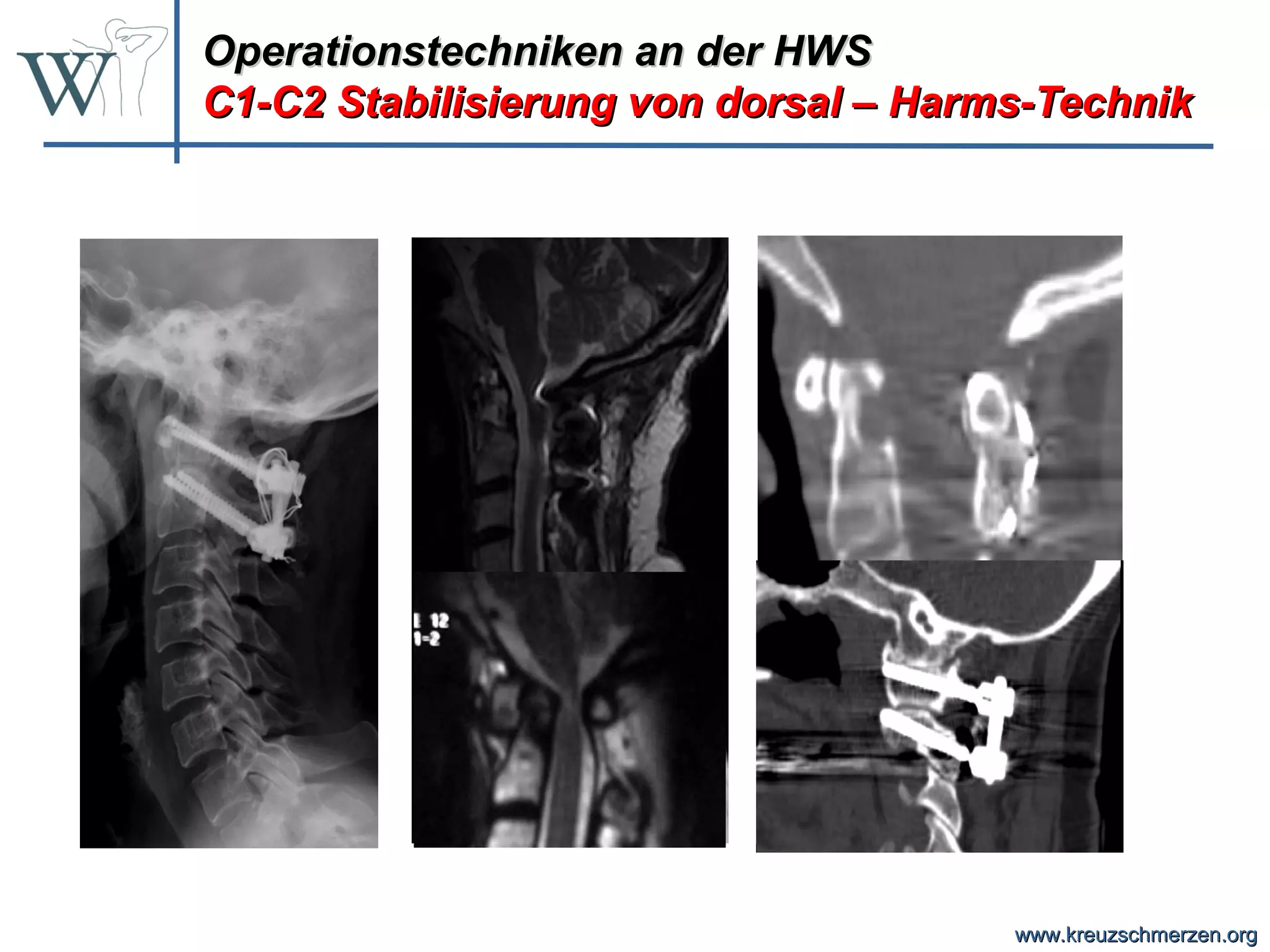 The cervical myelopathy. | PPT